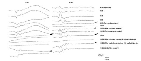 Intraoperative Laryngeal Adductor Reflex Findings Right Laryngeal
