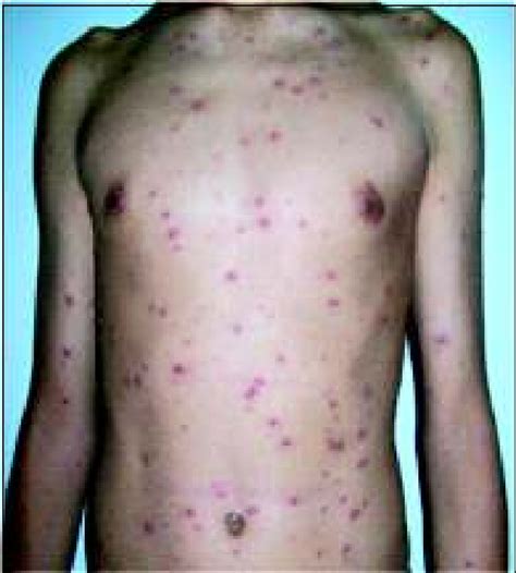 Vesiculopapular Rash With Crusts Involving The Trunk And Upper Limbs Download Scientific