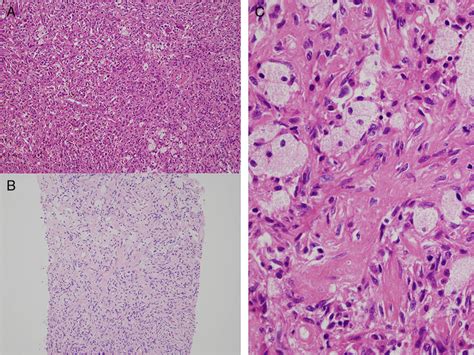 Histopathologic Findings With Hematoxylin And Eosin Hande Stain A A
