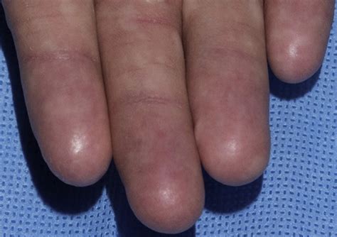 Progressive Reticulate Skin Pigmentation And Anonychia In A Patient
