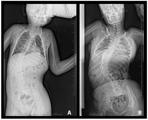 Severe Thoracic Scoliosis
