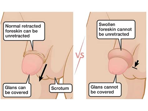 Paraphimosis Treatment Dorsal Slit