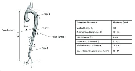Three Dimensional Generated Patient Specific Type B Aortic Dissection Download Scientific
