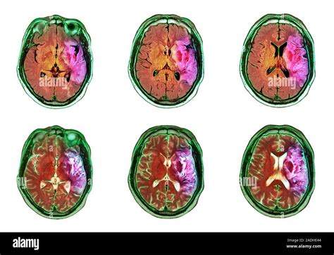 Stroke Coloured Computed Tomography Ct Brain Scans Axial View Through The Brain Of A 38