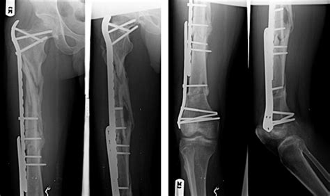 6 Month Postoperative Radiograph Showing Bridging Callus At The