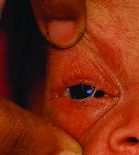 Nose Webbing Birth Defect