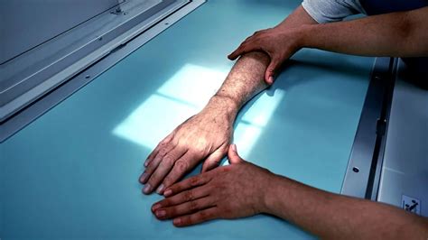 scaphoid fracture treatment symptoms and recovery