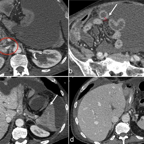 Contrast Enhanced Ct Images In The Portal Venous Phase A And B And Download Scientific