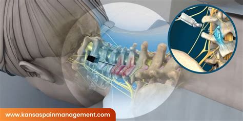 Medial Branch Block Mbb In Kansas City
