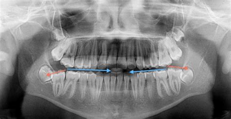 Normal Wisdom Teeth X Ray