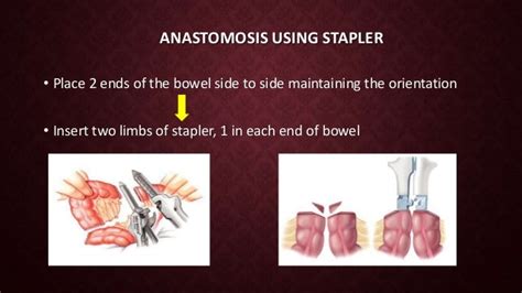 Intestinal Anastomosis And Staplers