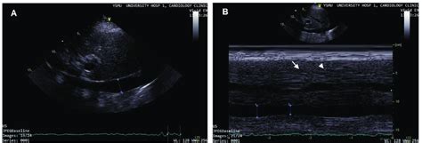 A Increased Ivc Diameter In A Patient With High Right Atrial