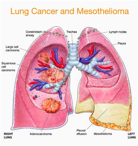 Cancer Treatment Pleural Mesothelioma Symptoms