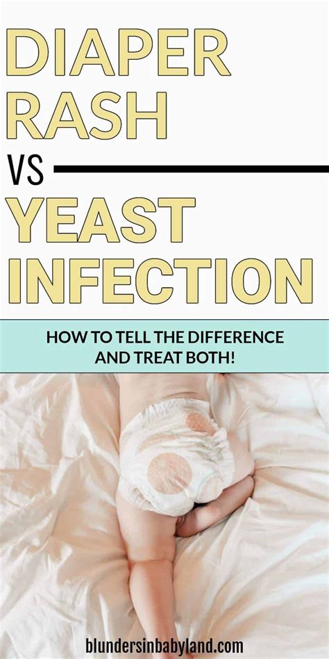 Severe Diaper Rash Treatment From A Mom Whose Tried It All Artofit