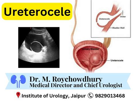 Ureterocele Figure 3 From Prolapsing Ectopic Ureterocele Presenting As Ureterocele Figure 3 From Prolapsing Ectopic Ureterocele Presenting As