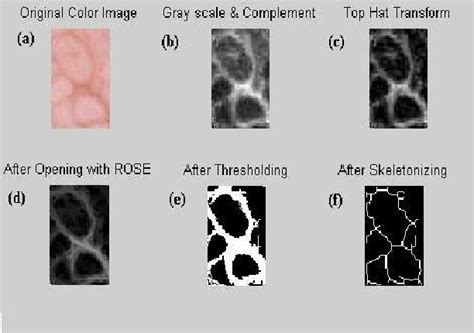 Figure From Segmentation And Classification Of Cervix Lesions By Pattern And Texture Analysis