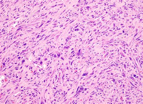 Undifferentiated Pleomorphic Sarcoma Light Micrograph Stock Image C057 3168 Science Photo
