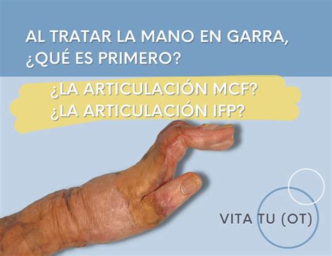 Prioridad Al Tratar La Mano En Garra ¿las Articulaciones Mcf O Las