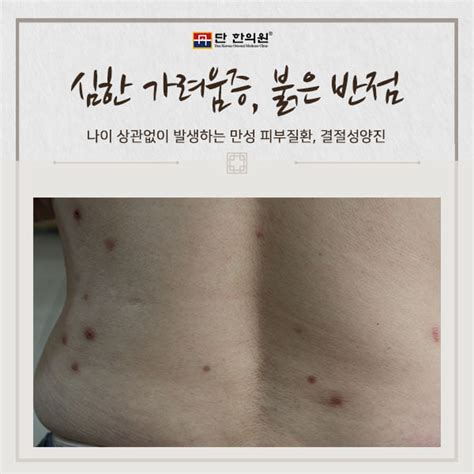 단한의원 심한 가려움증 붉은 반점의 결절성양진 구진이 나타나면서 진물 딱지가 반복돼요😠