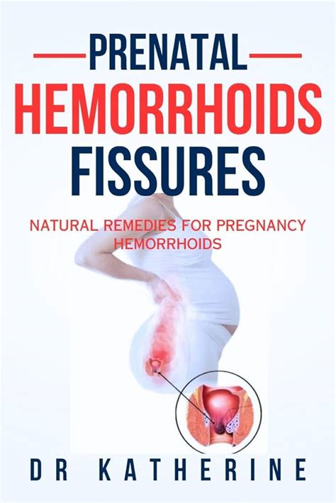 External Hemorrhoids In Pregnancy Treatment