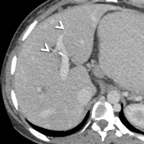 Axial Ct Demonstrating Prominent Portocaval And Periportal Download Scientific Diagram