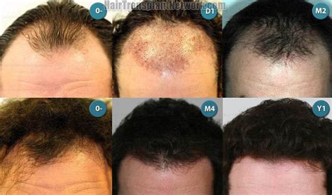Dr Jean Devroye Hair Restoration Surgery Before And After Result