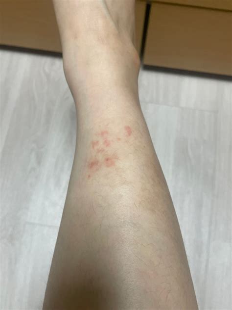 피부병변 질문 지식in