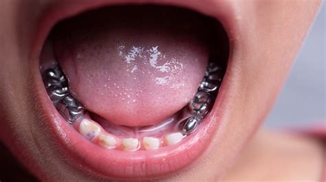 Epa Amalgam Separator Law Explained Healthfirst