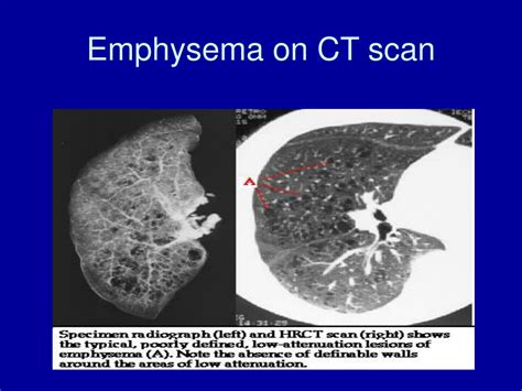 Ppt Pulmonary Function Tests Powerpoint Presentation Free Download
