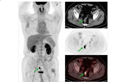 A 52 Year Old Man Had Right Partial Nephrectomy For Papillary Renal Download Scientific Diagram