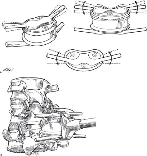Posterior Facet Joint Replacement Neupsy Key
