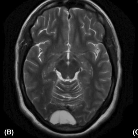 A T1‐weighted Axial Mri B T2‐weighted Axial Mri And C