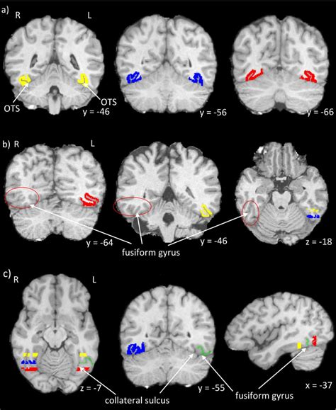 [pdf] Ventral Occipito Temporal Cortex Function And Anatomical