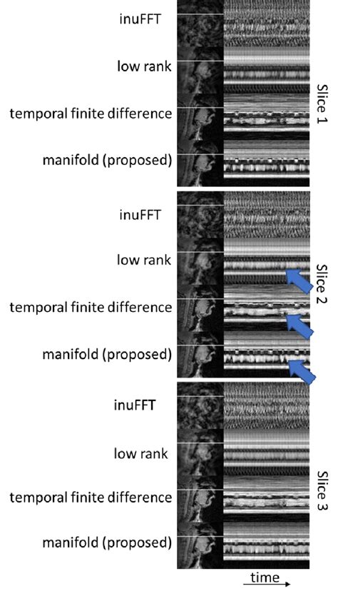 Qualitative Comparison Of Reconstructions From The Inufft Low Rank Download Scientific Diagram