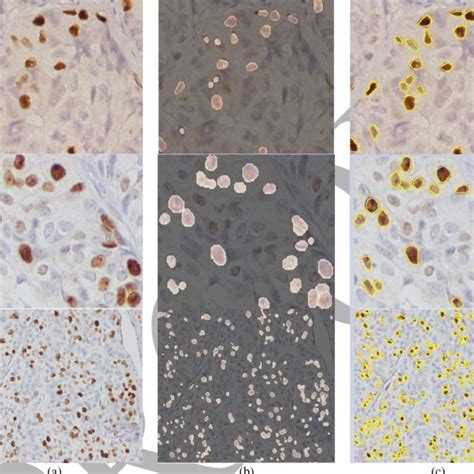 Major Steps Of Cancerous Cells Segmentation A Rgb Original Image
