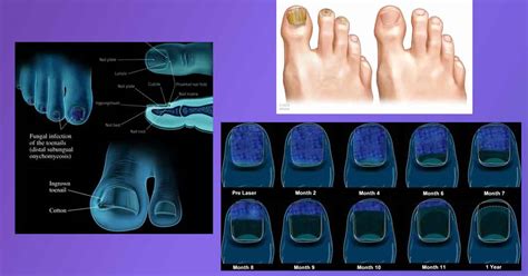 Как се отървах от гъбички по ноктите ДокторБГ