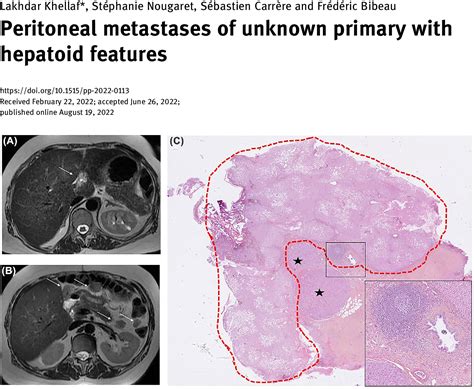 Peritoneal Metastases Of Unknown Primary With Hepatoid Features