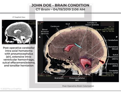 Tbi Essentials Focus Graphics