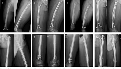 Figure 1 From Reliability Of RUST And Modified RUST Scores For Evaluation Of Union In Pediatric