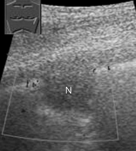 Transcutaneous Contrast Enhanced Sonography Of Peripheral Lung Lesions