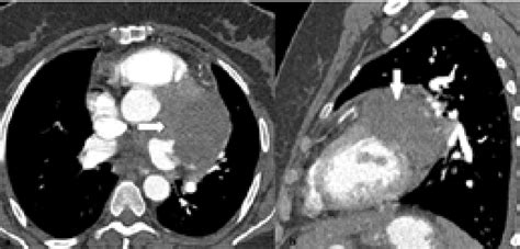 High Grade Pleomorphic Sarcoma In A 47 Year Old Female Patient 2 A B Download Scientific