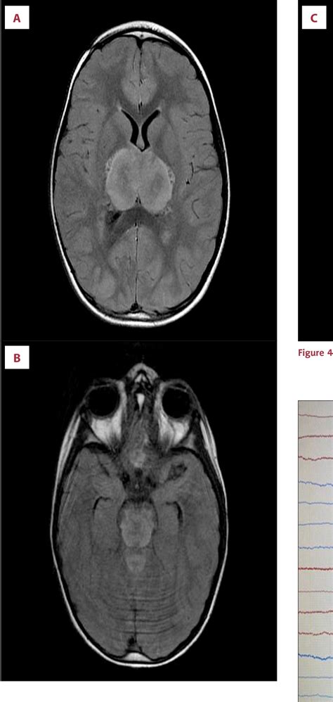 Figure 5 From A Young Girl With Acute Encephalopathy Who Presented With