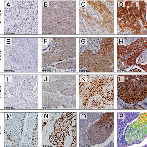 Ihc Of Gpnmb Egfr P Pi3k And Ki 67 In Escc A To D Represent Download Scientific Diagram