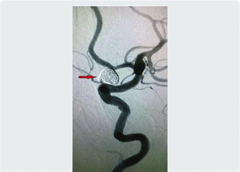 Cerebral Arteries After Embolization Download Scientific Diagram