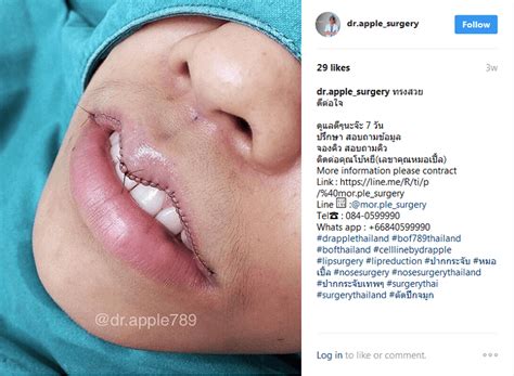 နှုတ်ခမ်းလှီးကြဦးမလား၊ လှချင်သူများ Yoyarlay Digital Media And News