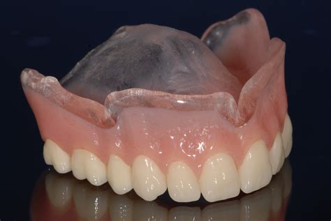 What Is Extension Base Denture At Frank White Blog