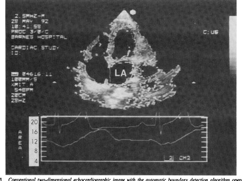 Figure 1 From On Line Assessment Of Left Atrial Area And Function By Echocardiographic Automatic