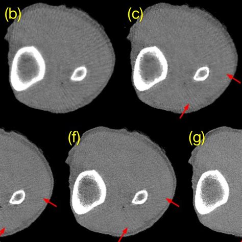 Qualitative Sparse View Cbct Artifact Reduction Results By Different Download Scientific