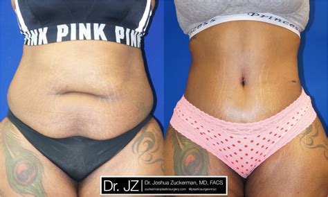Will A Tummy Tuck Eliminate Stretch Marks Zuckerman Plastic Surgery