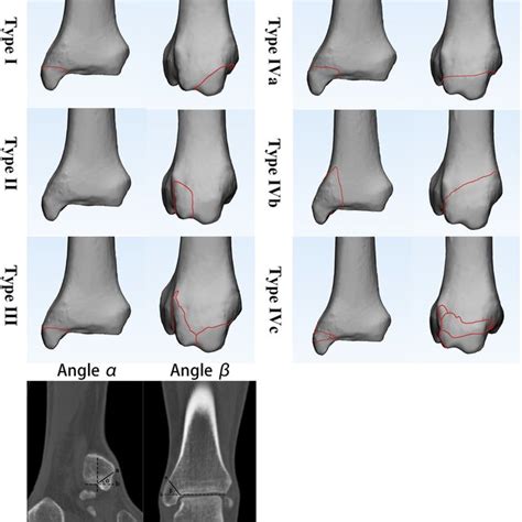 An Illustration Of The Modified Classification System Of Medial